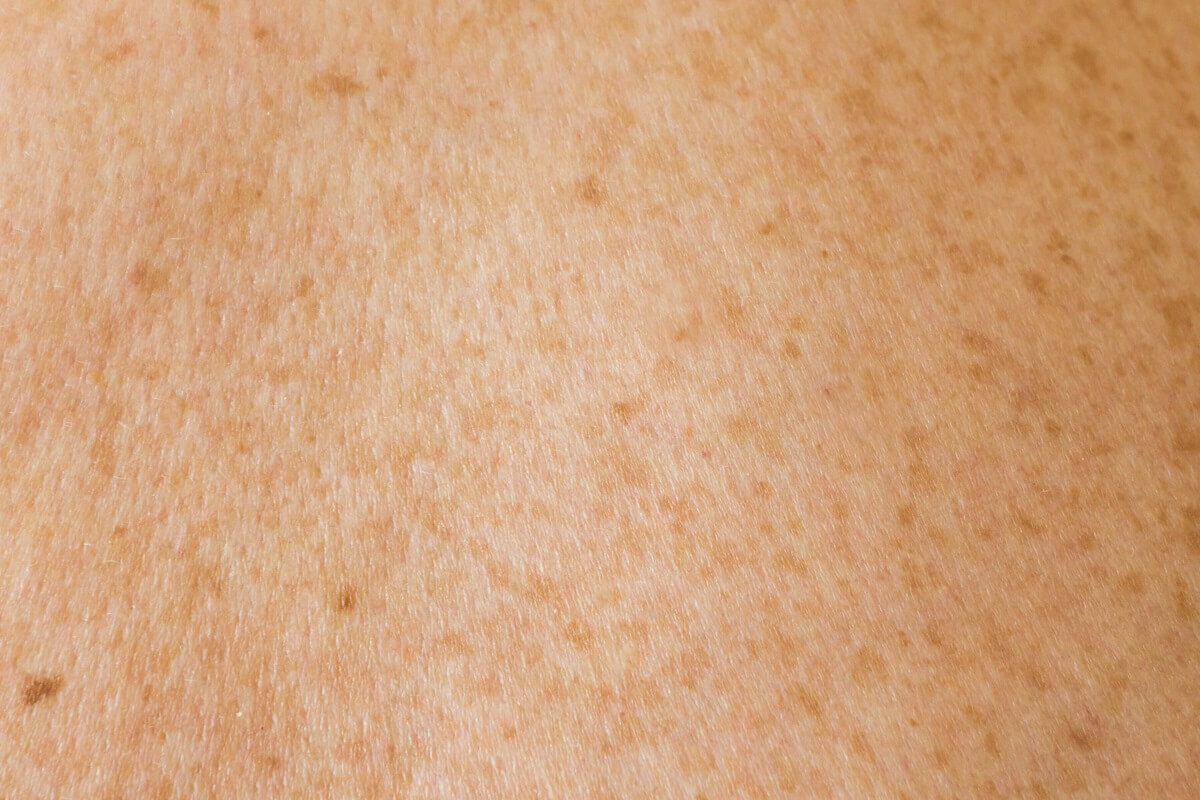 Les mélanomes : tout ce qu’il faut savoir sur ces cancers de la peau - MÊME